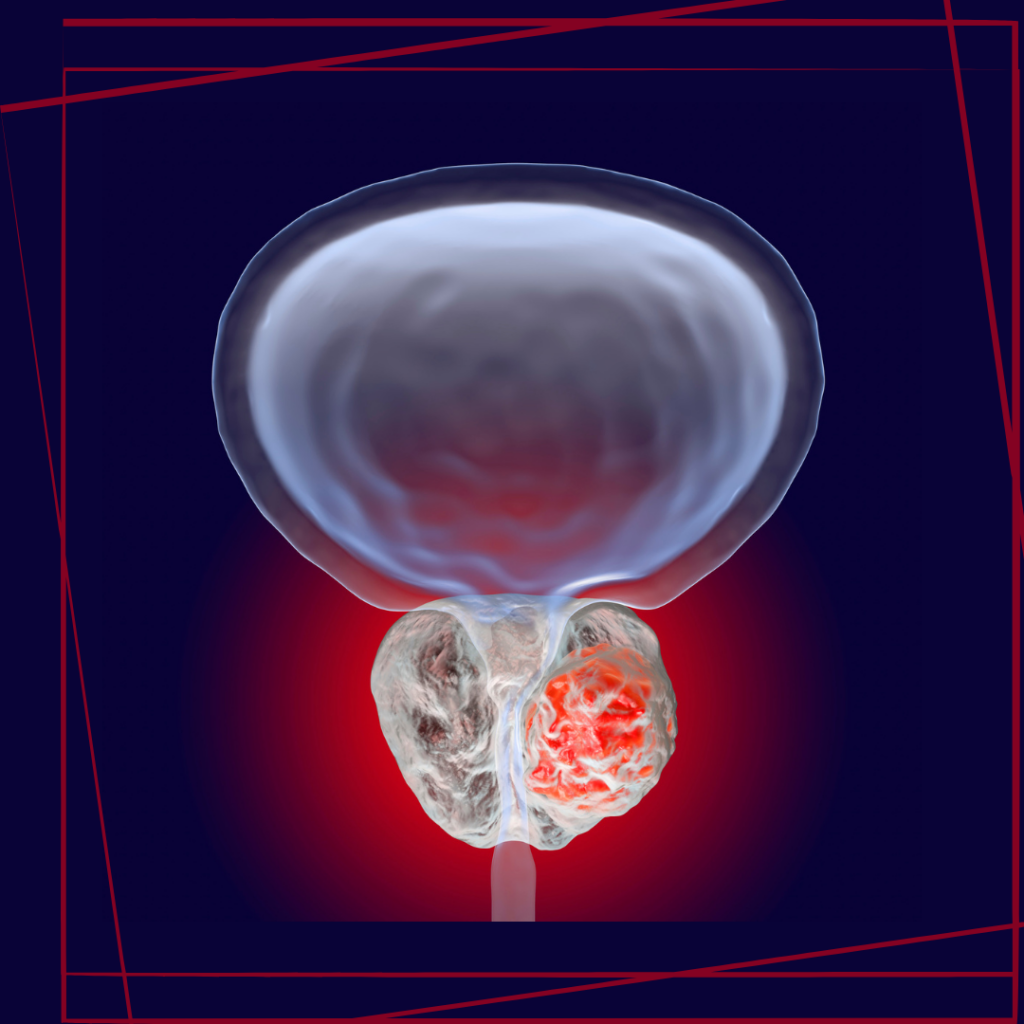 Καλοήθεις παθήσεις του προστάτη | ΡΕΑ Μαιευτήριο