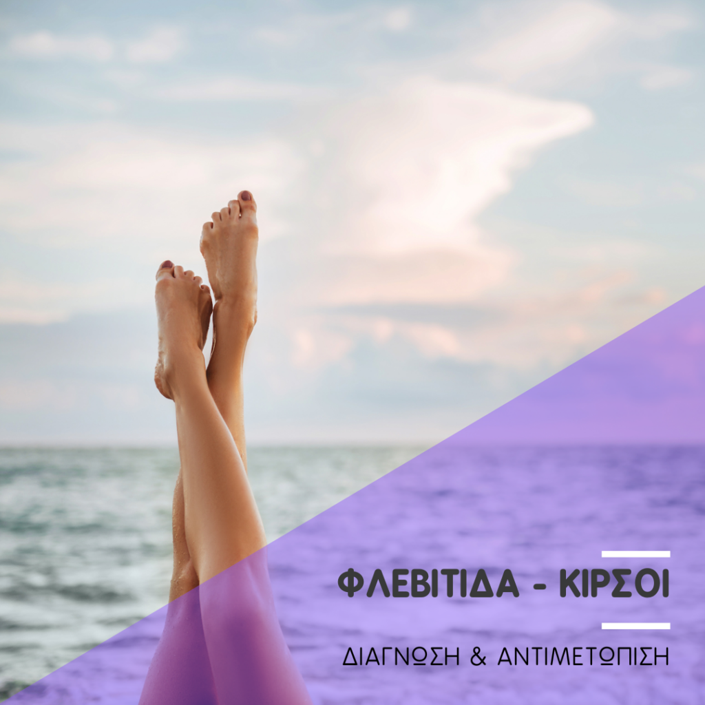 Φλέβιτιδα – Κιρσοί: Γιατί να έχετε το πρόβλημα και αυτό το καλοκαίρι ...